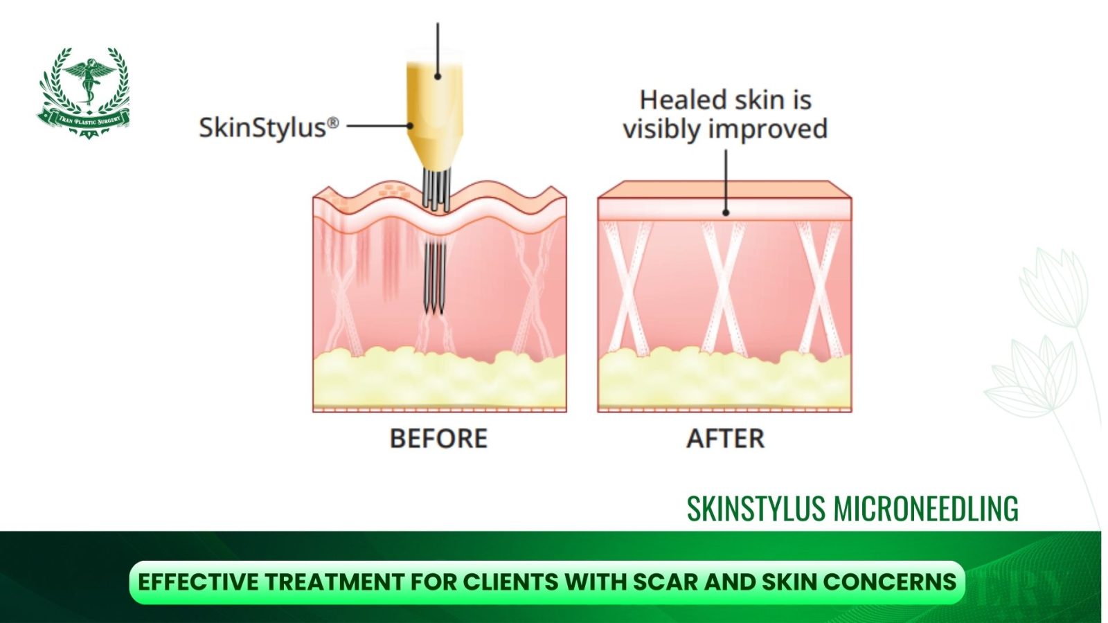 SkinStylus Microneedling in Huntington Beach, CA | Tran Plastic Surgery