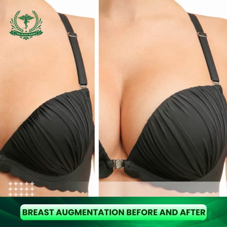 Breast Augmentation Sizes 300cc To 600cc Implants Guide Tran Plastic 0418
